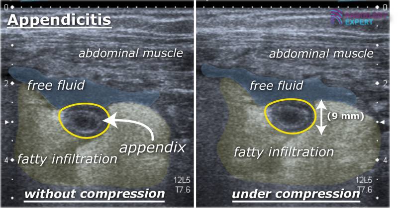 Abdominal ultrasound