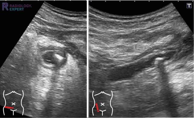 Abdominal ultrasound
