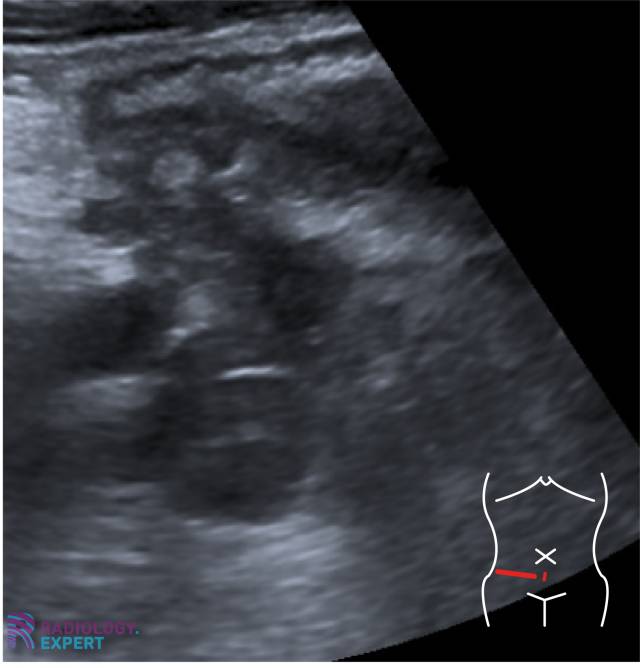 Abdominal ultrasound