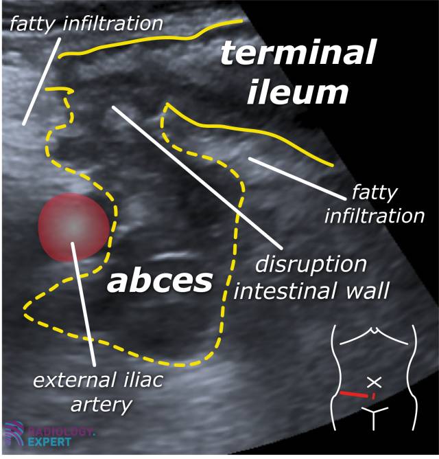Abdominal ultrasound