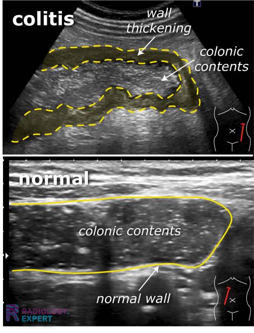 Abdominal ultrasound