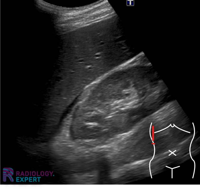 Abdominal ultrasound