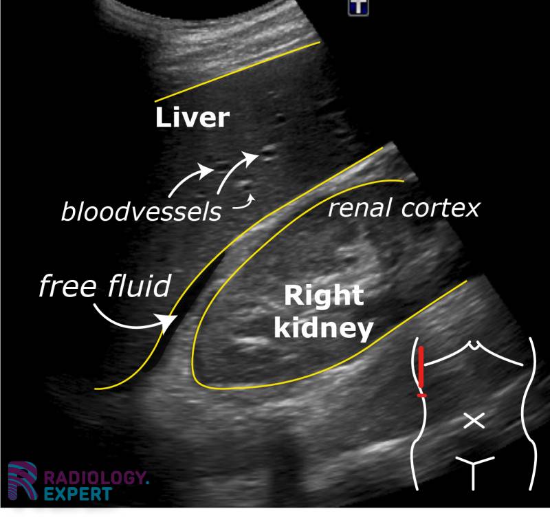Abdominal ultrasound