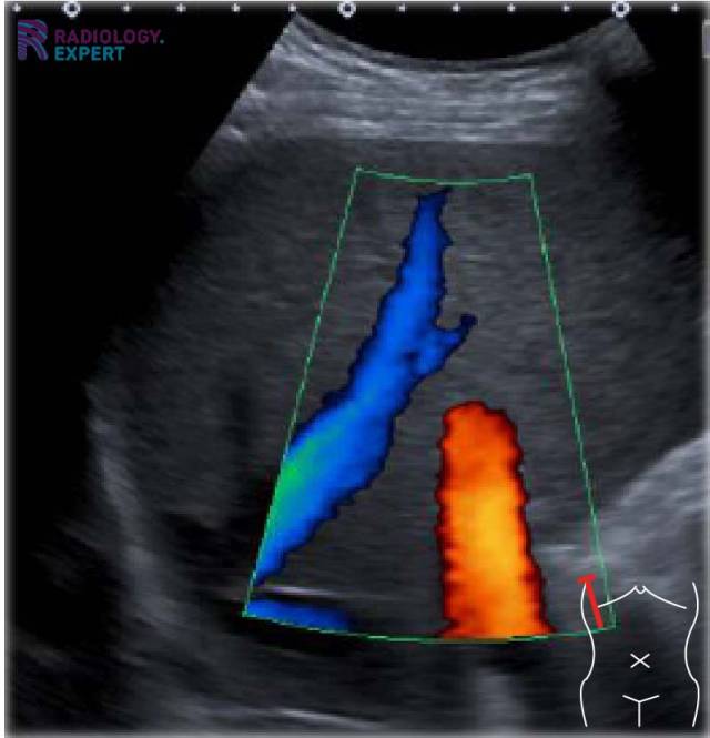 Abdominal ultrasound