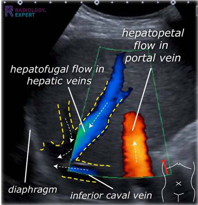 Hepatofugal Flow Ultrasound