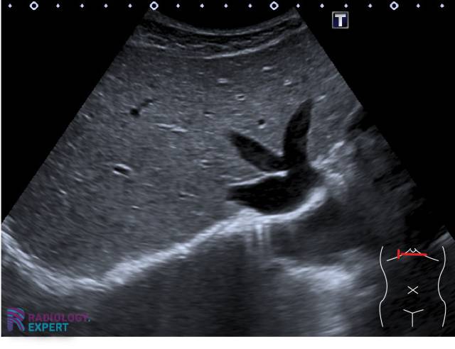 Bunny Rabbit Sign Ultrasound Ultrasound Guided Block Of The Sciatic