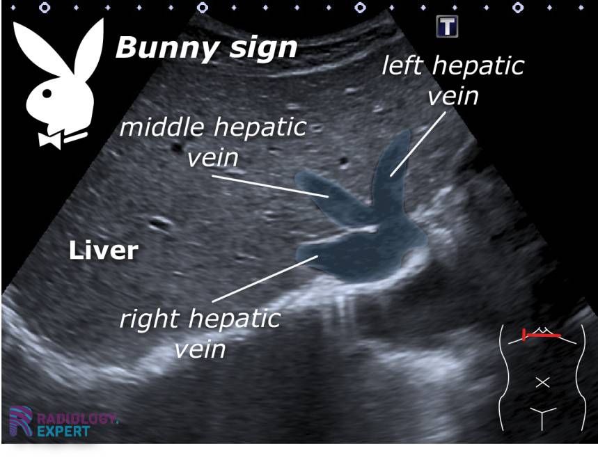 Abdominal ultrasound