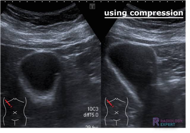 Abnormal Abdominal Ultrasound Startradiology