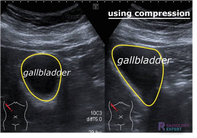 Abdominal ultrasound