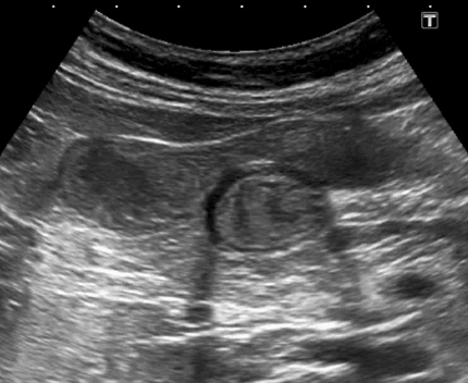 Echo abdomen