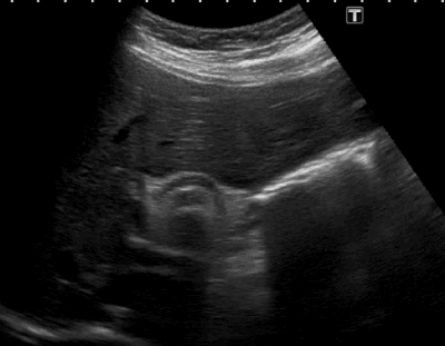 Abdominal ultrasound