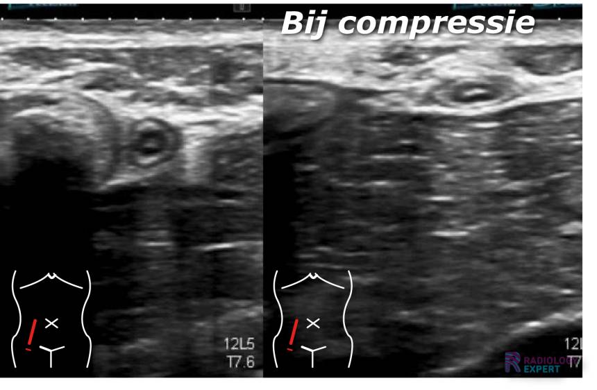 Echo abdomen