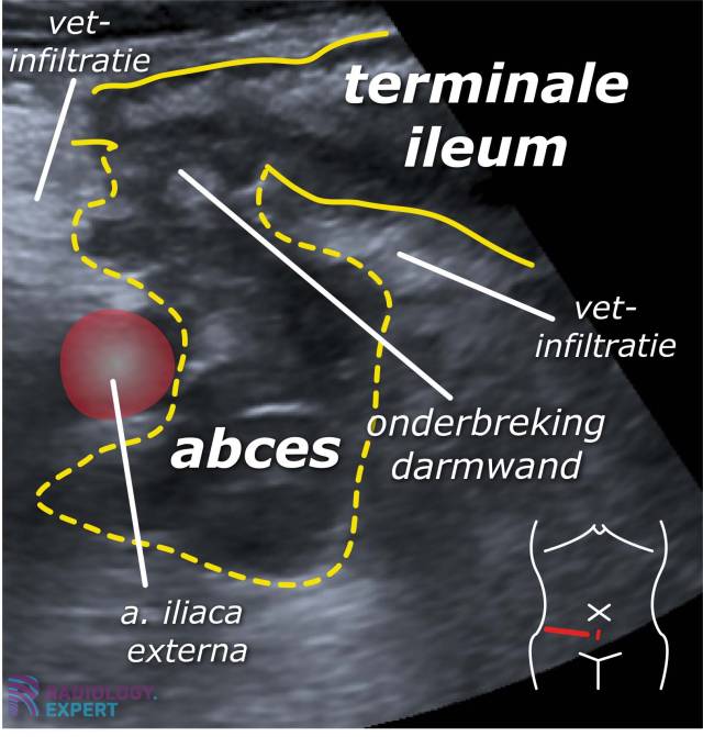 Echo abdomen