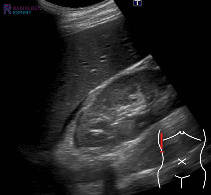 Echo abdomen