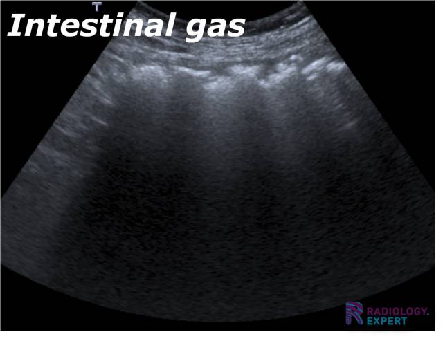 Ultrasound Technique