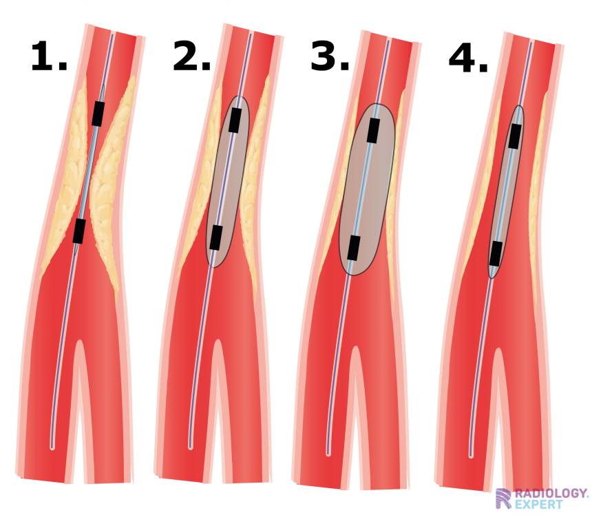 Vascular Intervention