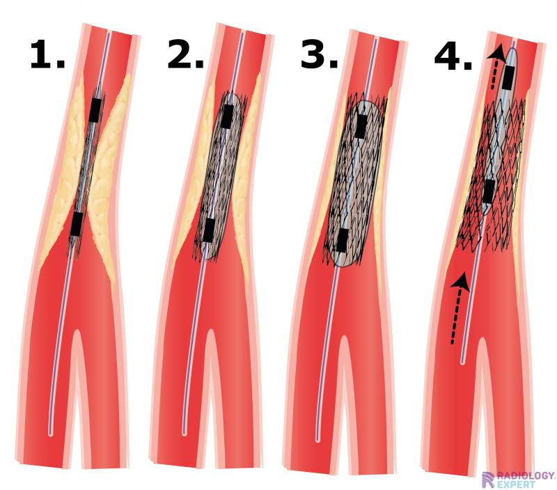 Vascular Intervention