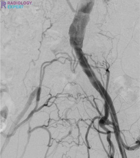 Vascular Intervention