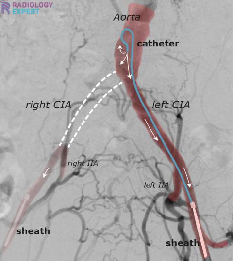 Vascular Intervention