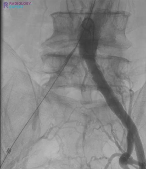 Vascular Intervention