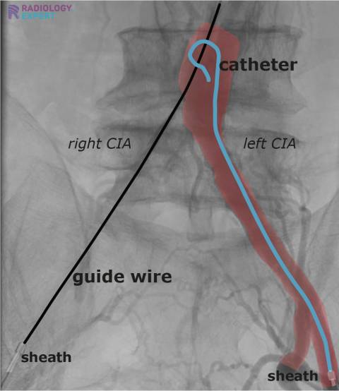 Vascular Intervention