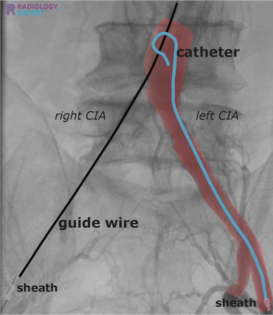 Vascular Intervention