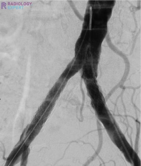 Vascular Intervention