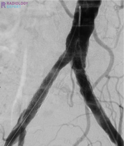 Vascular Intervention