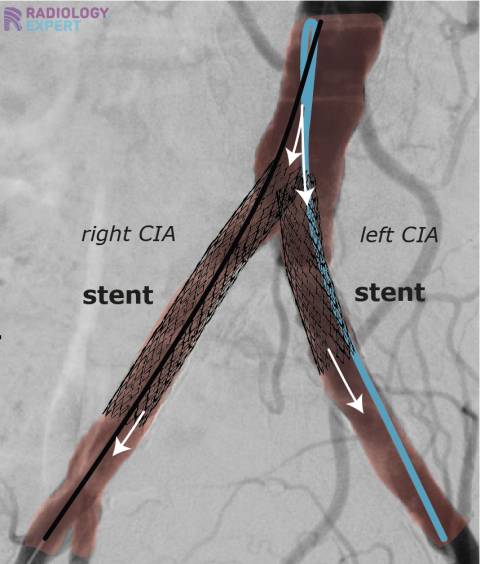 Vascular Intervention