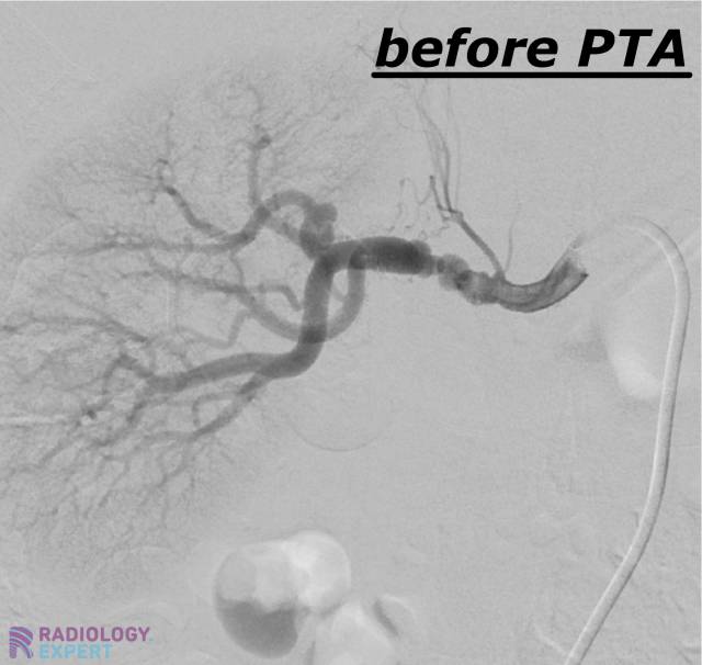 Vascular Intervention