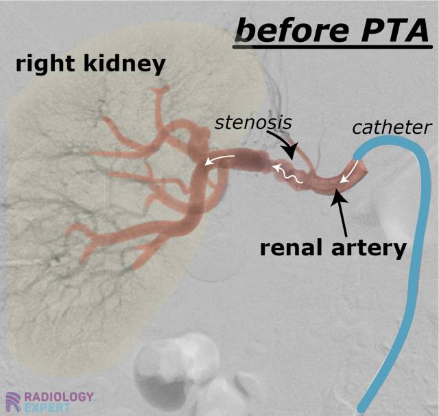 Vascular Intervention