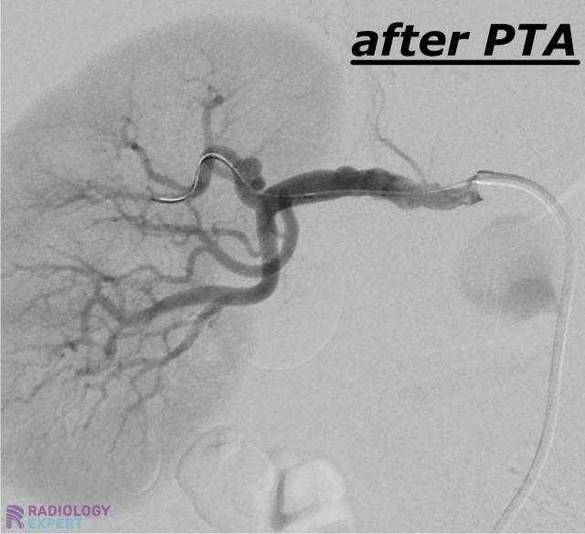 Vascular Intervention