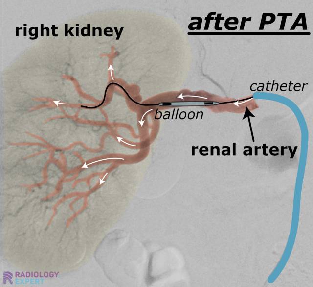 Vascular Intervention