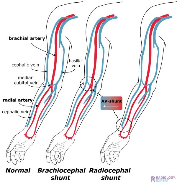Vascular Intervention