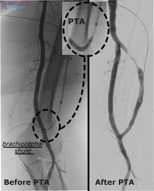 Vascular Intervention
