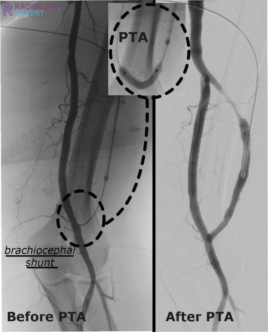 Vascular Intervention