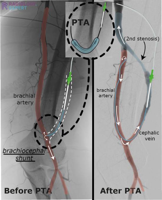 Vascular Intervention