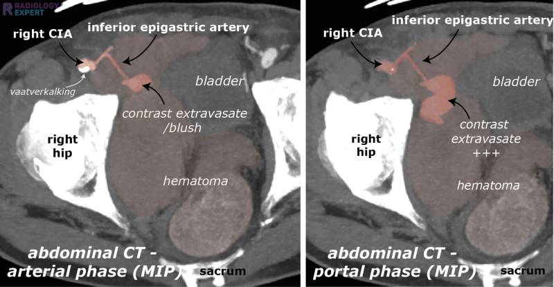 Vascular Intervention