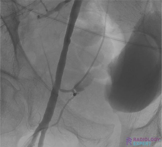 Vascular Intervention