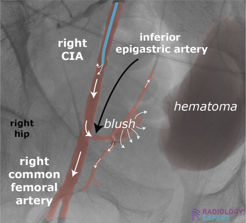 Vascular Intervention