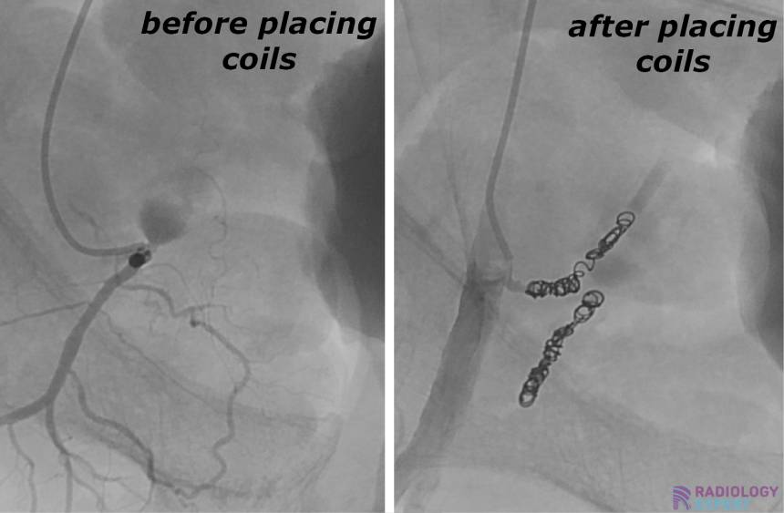 Vascular Intervention