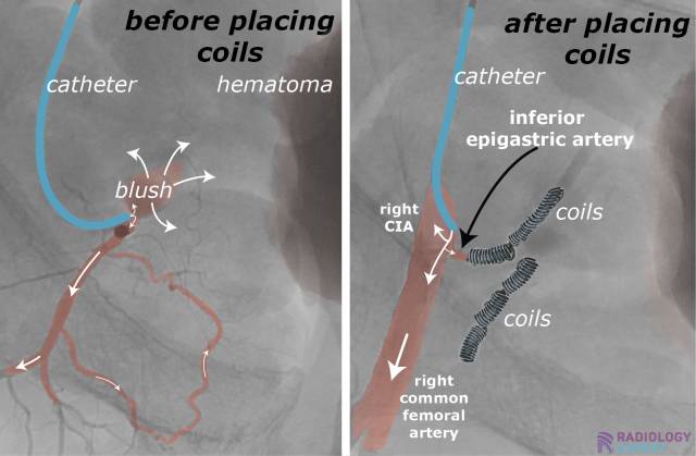 Vascular Intervention