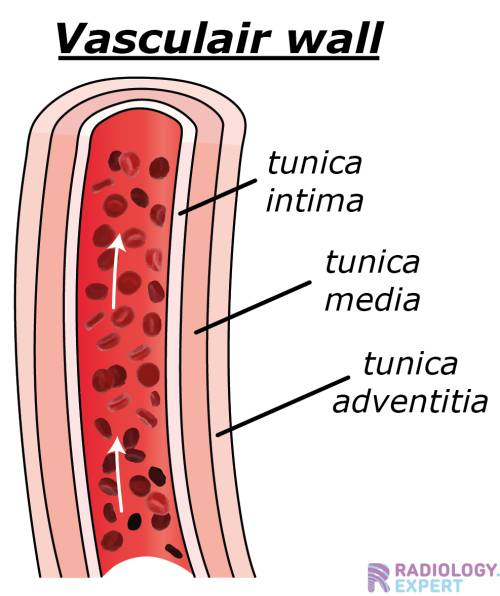 Vascular Intervention