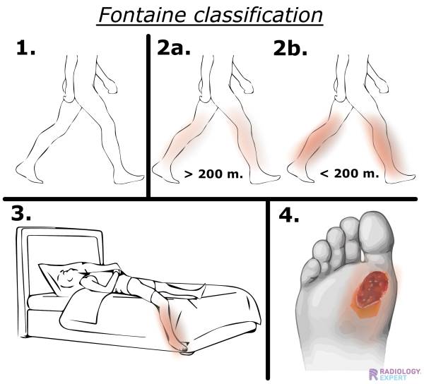 Vascular Intervention