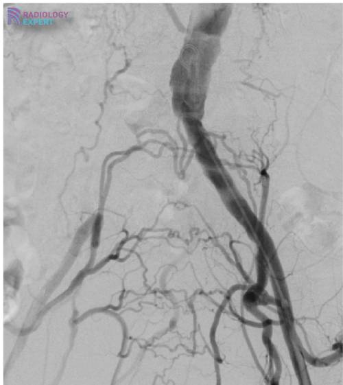 Vasculaire Interventie