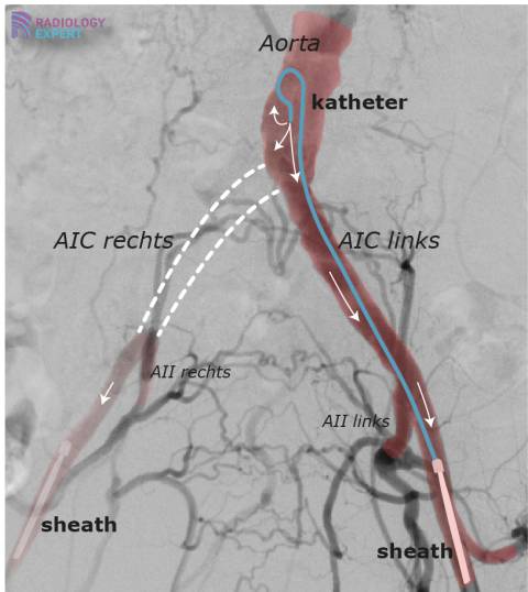 Vasculaire Interventie
