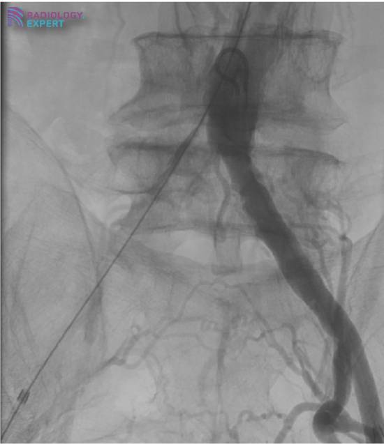 Vasculaire Interventie