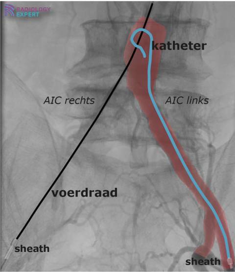 Vasculaire Interventie