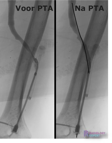 Vasculaire Interventie