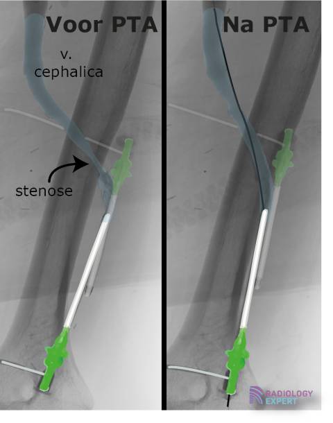 Vasculaire Interventie